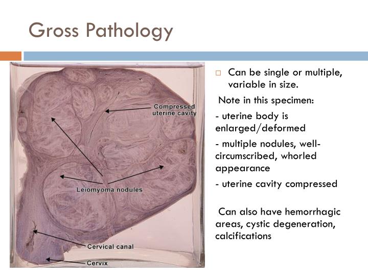 PPT - Uterine Leiomyomas PowerPoint Presentation - ID:5528131