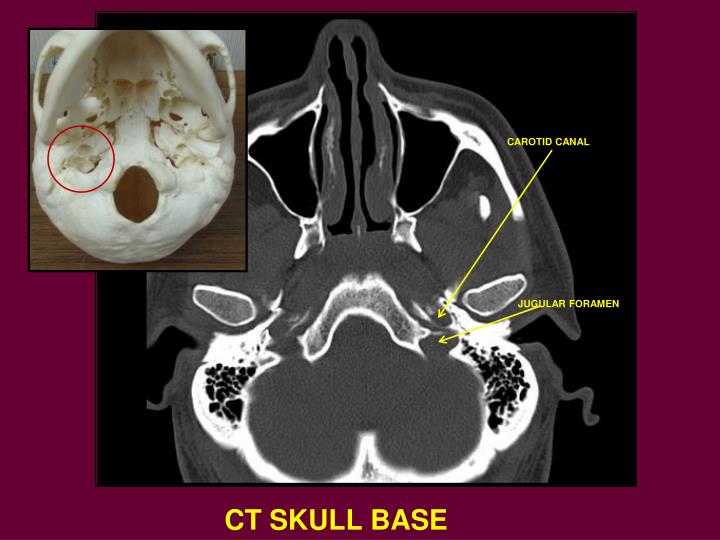 PPT - M-1 RADIOLOGY Head and Neck PowerPoint Presentation - ID:5537403