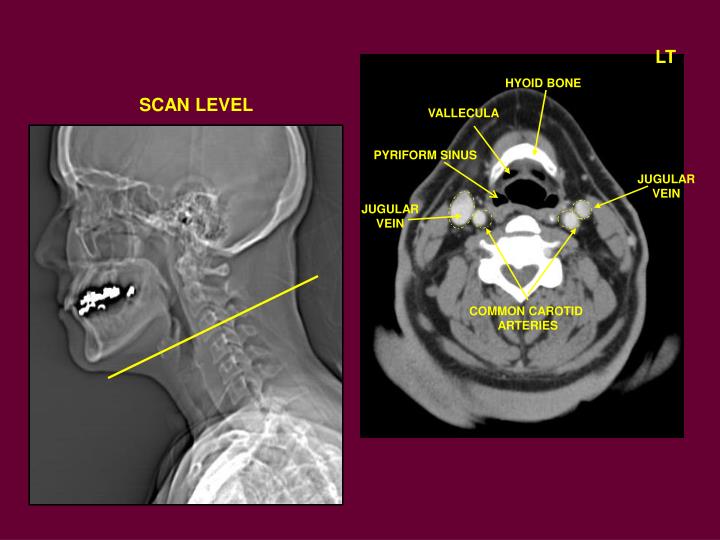 PPT - M-1 RADIOLOGY Head and Neck PowerPoint Presentation - ID:5537403