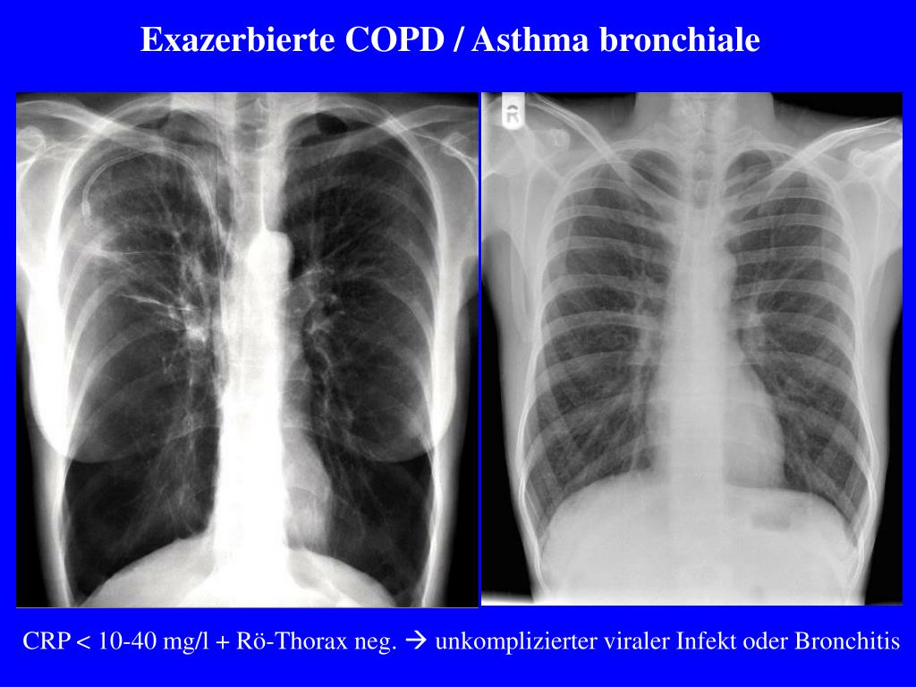 PPT - Beitrag der Radiologie zur Abklärung der Dyspnoe PowerPoint ...