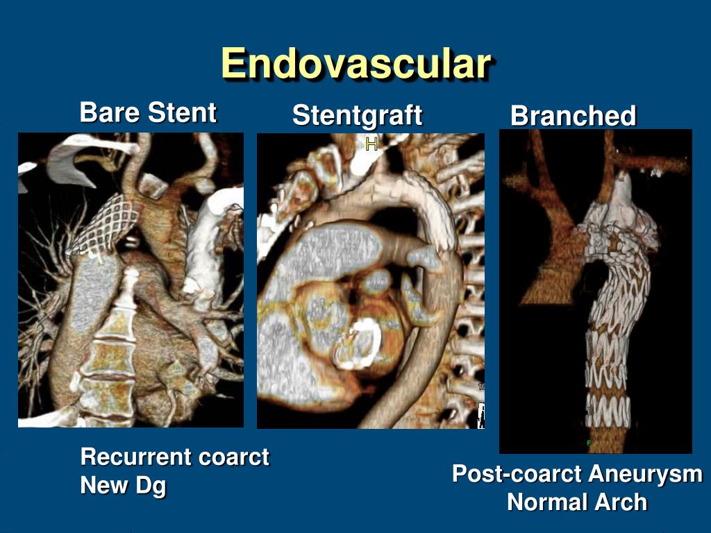 PPT - Evolving treatment strategies for aortic coarctation and late ...