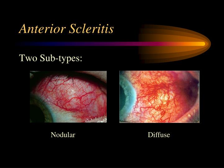 PPT - Scleritis Diagnosis & Management PowerPoint Presentation - ID:5542222