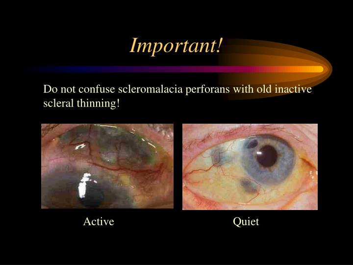 PPT - Scleritis Diagnosis & Management PowerPoint Presentation - ID:5542222