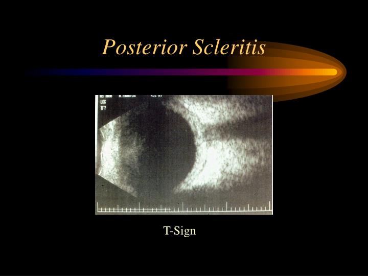 PPT - Scleritis Diagnosis & Management PowerPoint Presentation - ID:5542222