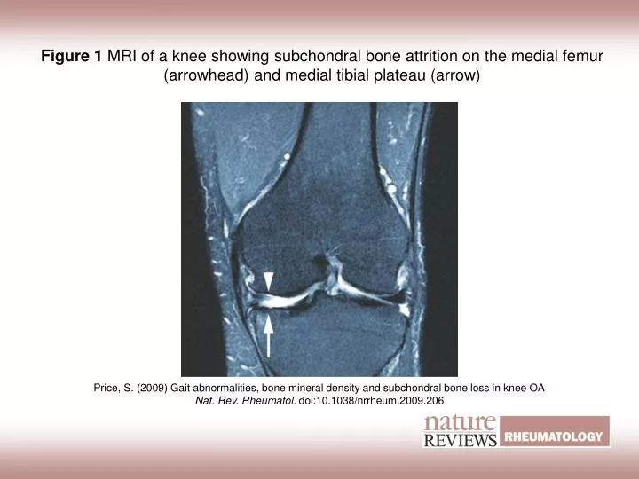PPT - Price, S. (2009) Gait abnormalities, bone mineral density and ...