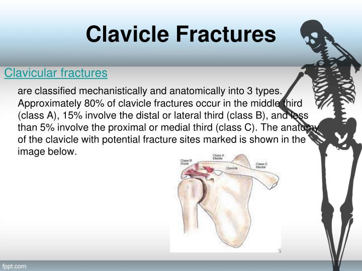 PPT - Clavicle Fractures PowerPoint Presentation - ID:5548459