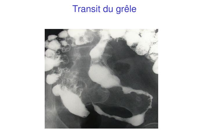 PPT - Maladie de Crohn Ulcérations PowerPoint Presentation - ID:5552356