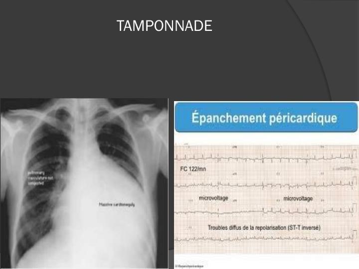 PPT - LES PERICARDITES PowerPoint Presentation - ID:5561777