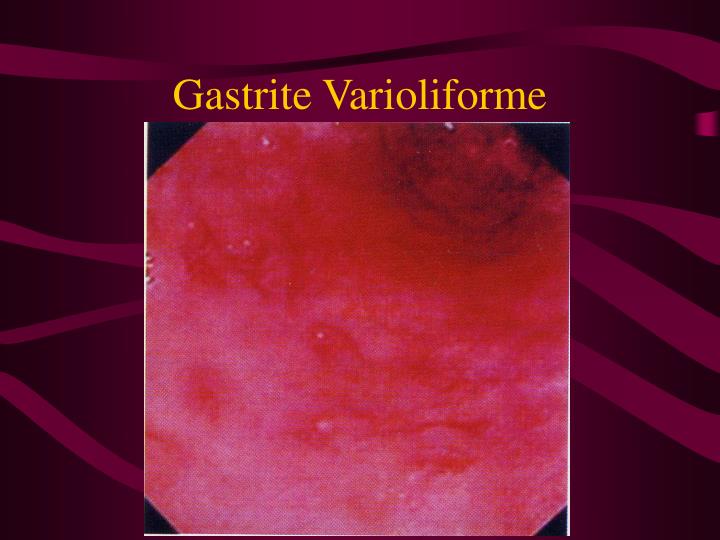 PPT - GASTRITES PowerPoint Presentation - ID:5561798