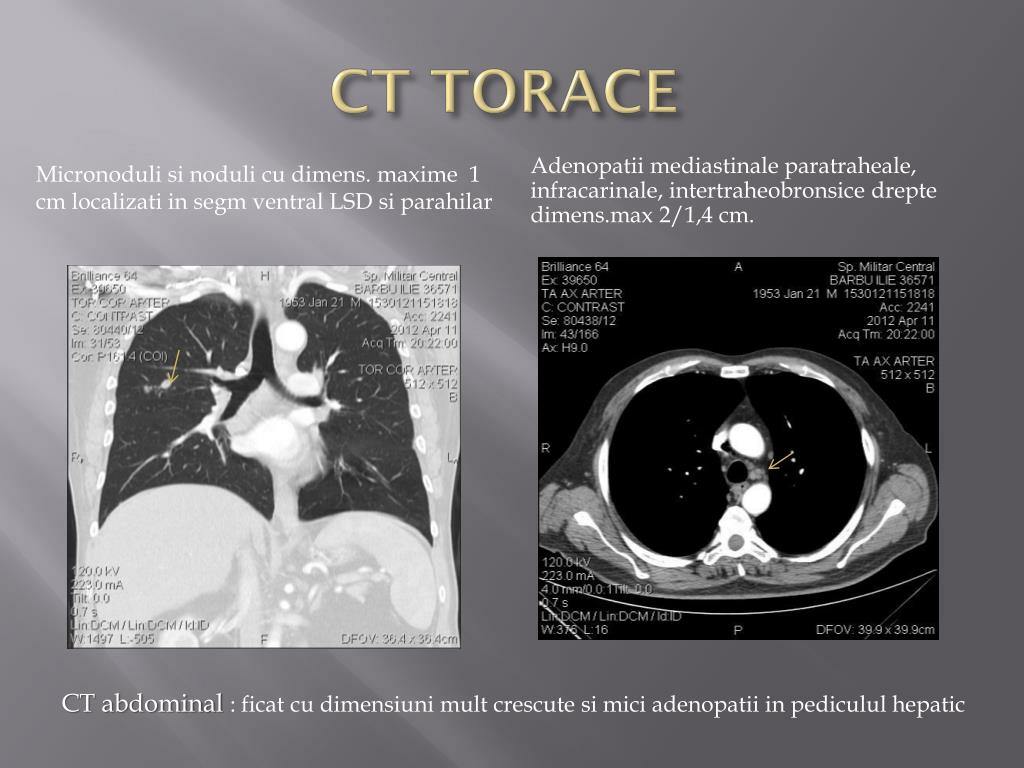 PPT - PROVOCARE DIAGNOSTICA – CE POATE ASCUNDE gRANULOMATOZA PowerPoint ...