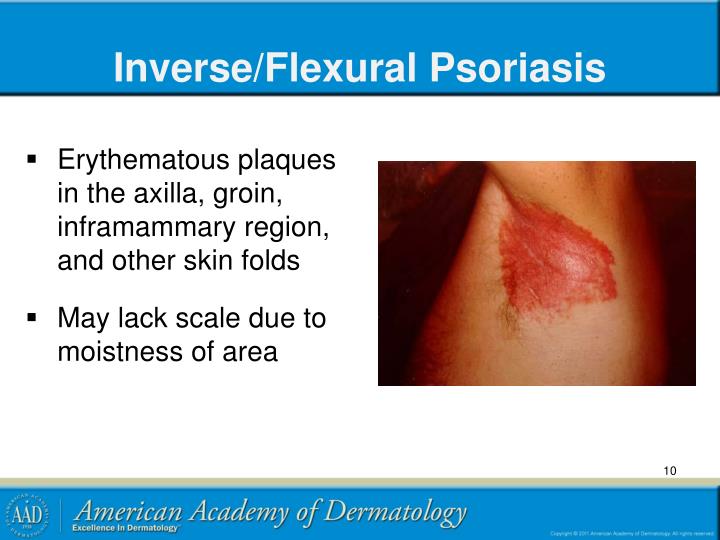 PPT - Psoriasis PowerPoint Presentation - ID:5572802