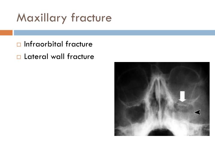 PPT - RADIOGRAPHIC INTERPRETATION OF INFECTION & TRAUMA PowerPoint ...
