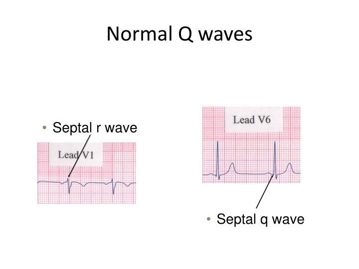 PPT - ECG Interpretation PowerPoint Presentation - ID:5576062