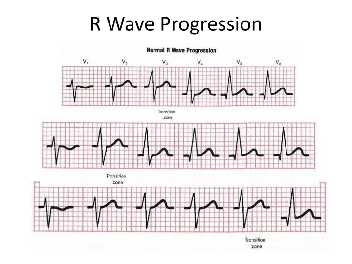 PPT - ECG Interpretation PowerPoint Presentation - ID:5576062