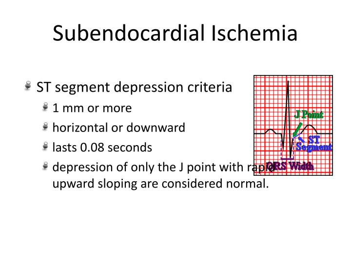 PPT - ECG Interpretation PowerPoint Presentation - ID:5576062