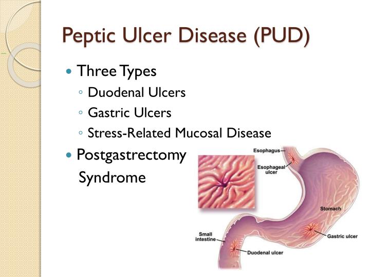 PPT - Alterations of the GI Tract PowerPoint Presentation - ID:5576803