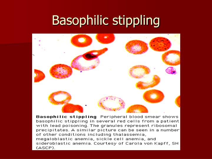 Basophilic Stippling Thalassemia