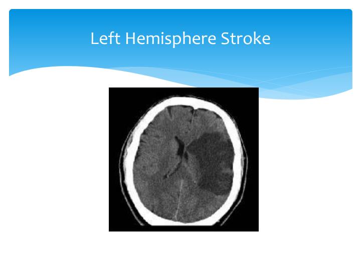 PPT - Acute Stroke - the role of EMS PowerPoint Presentation - ID:5577579
