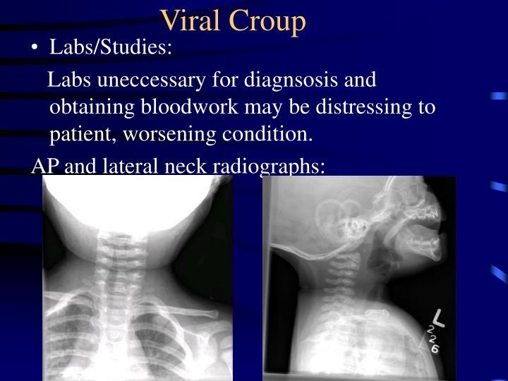 PPT - Stridor and Upper Airway Obstruction PowerPoint Presentation - ID ...