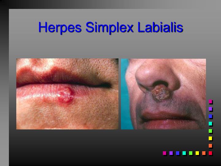 PPT - Viral Skin Diseases PowerPoint Presentation - ID:5588920