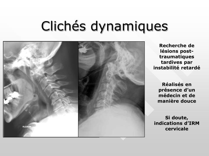 PPT - EXPLORATION RADIOLOGIQUE DU RACHIS CERVICAL ET LOMBAIRE ...