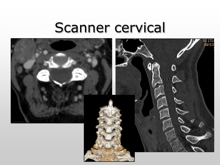PPT - EXPLORATION RADIOLOGIQUE DU RACHIS CERVICAL ET LOMBAIRE ...