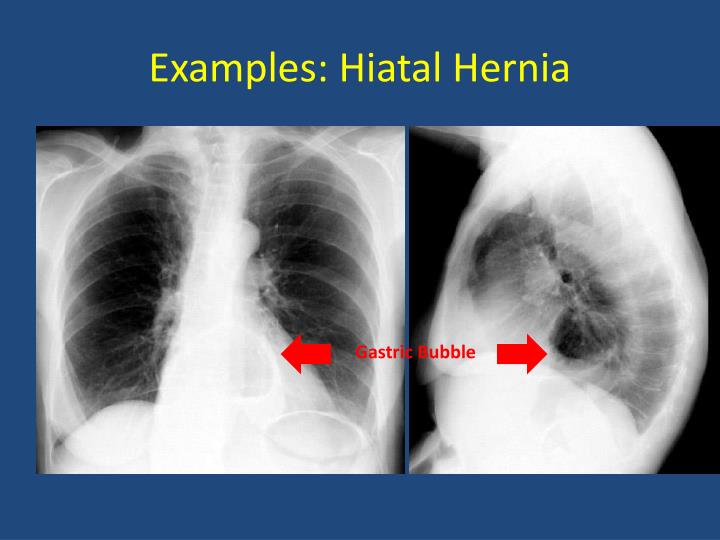 PPT - Basics of Chest X-Ray PowerPoint Presentation - ID:5595574