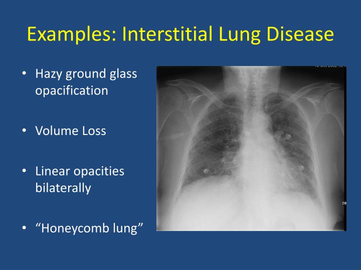 PPT - Basics of Chest X-Ray PowerPoint Presentation - ID:5595574