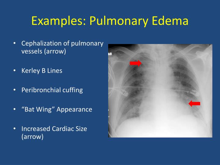 PPT - Basics of Chest X-Ray PowerPoint Presentation - ID:5595574