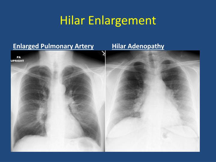 PPT - Basics of Chest X-Ray PowerPoint Presentation - ID:5595574