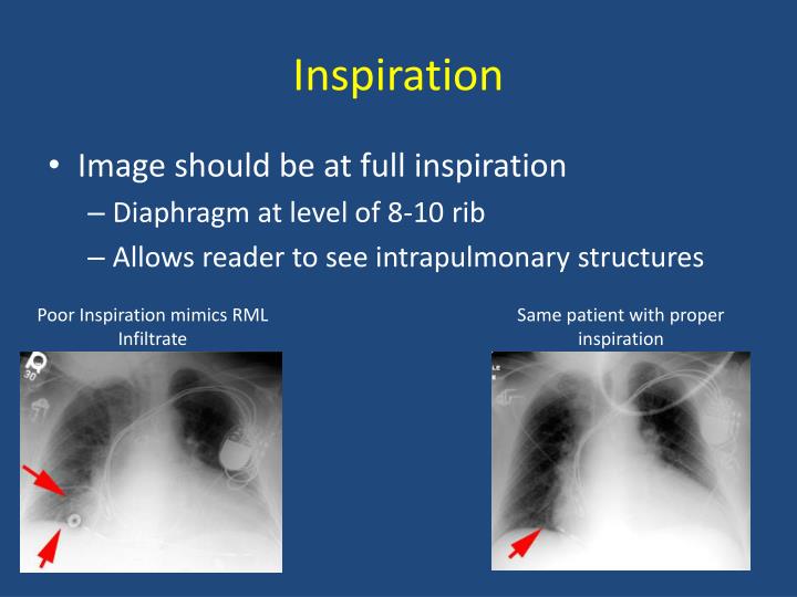 PPT - Basics of Chest X-Ray PowerPoint Presentation - ID:5595574