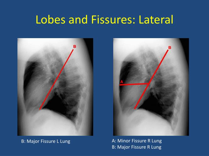 Ppt Basics Of Chest X Ray Powerpoint Presentation Id5595574