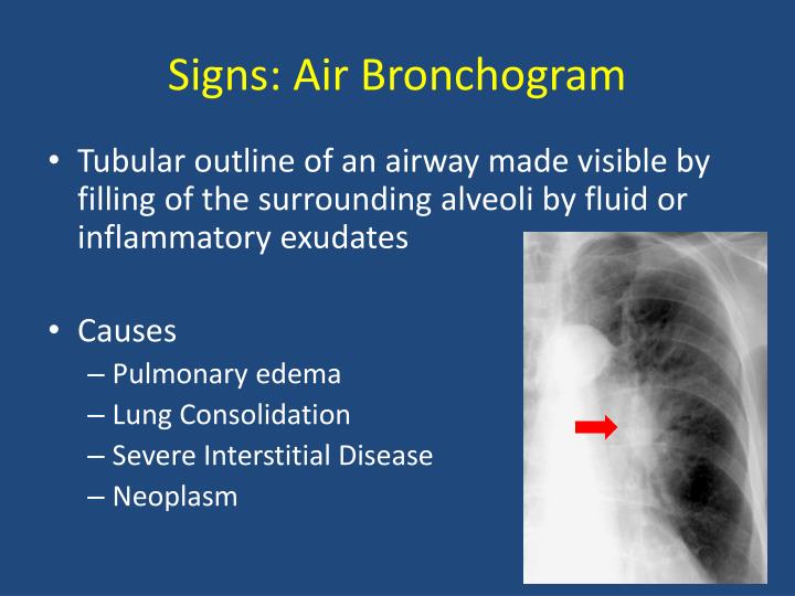 PPT - Basics of Chest X-Ray PowerPoint Presentation - ID:5595574