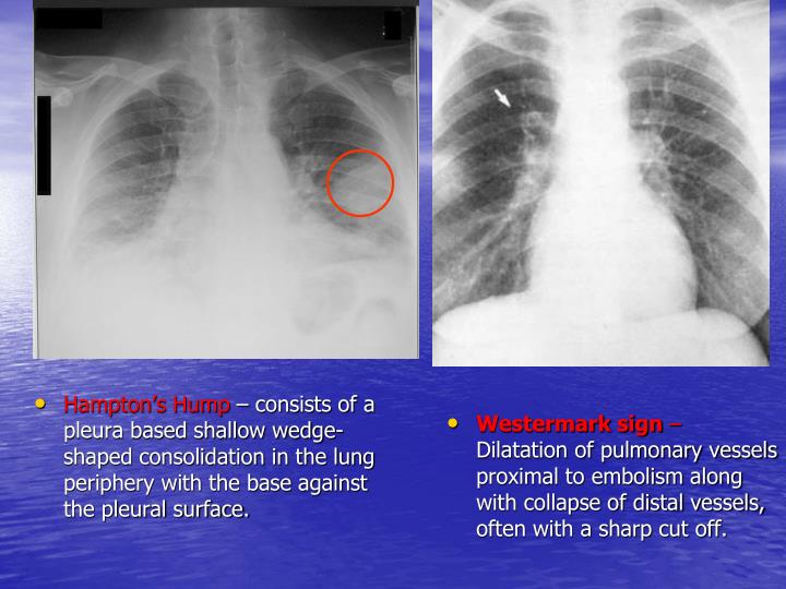 PPT - Radionuclide Pulmonary imaging (LUNG V/Q SCAN) PowerPoint ...