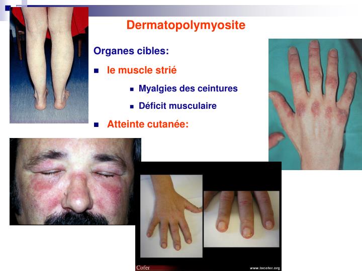 PPT - Maladies auto-immunes non spécifiques d’organe PowerPoint ...