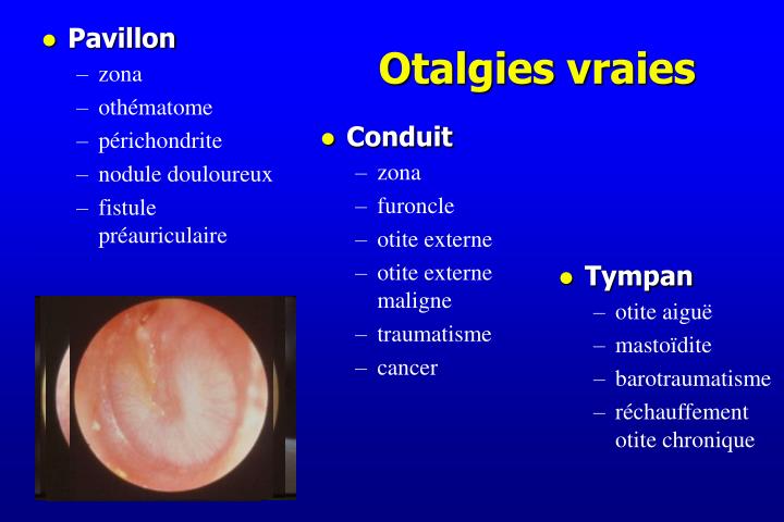 PPT - Otalgie Otites PowerPoint Presentation - ID:5597849