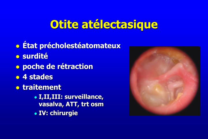 Otite virale adulte - Chad Hay