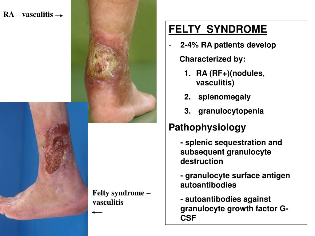 Felty Syndrome