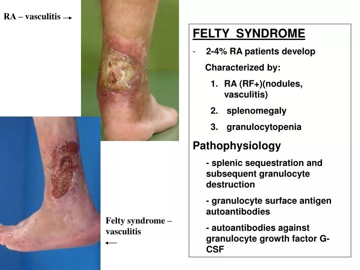 PPT - FELTY SYNDROME 2-4% RA patients develop Characterized by: RA (RF+ ...