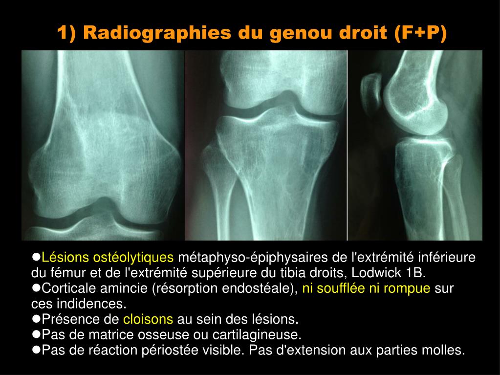 PPT - Lésions ostéolytiques multiples de découverte fortuite chez une ...