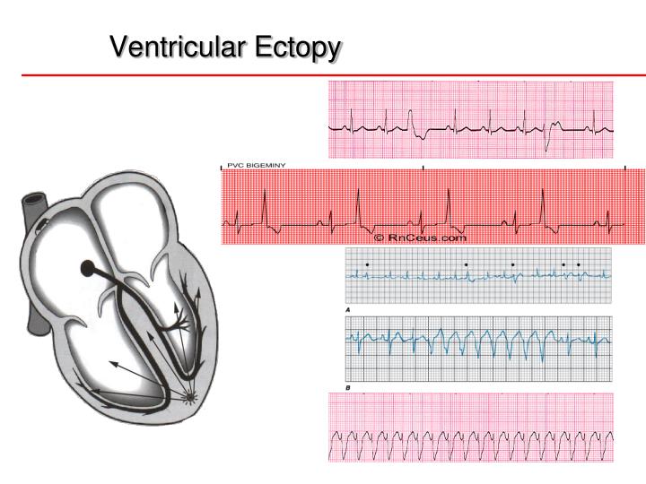 PPT - Nursing Priorities in Acute Coronary Syndromes PowerPoint ...