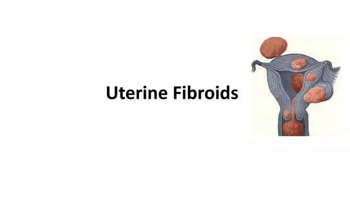 PPT - Uterine Fibroids PowerPoint Presentation - ID:5612276