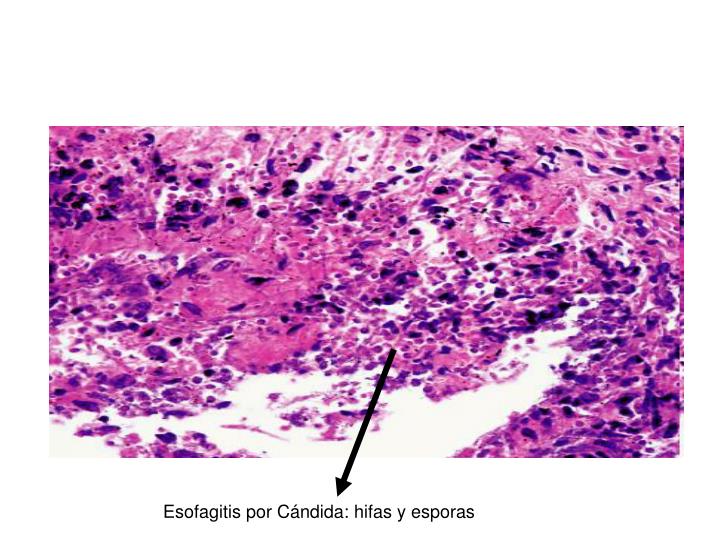 PPT - ESÓFAGO INFLAMACIÓN Y TUMORES PowerPoint Presentation - ID:5613581