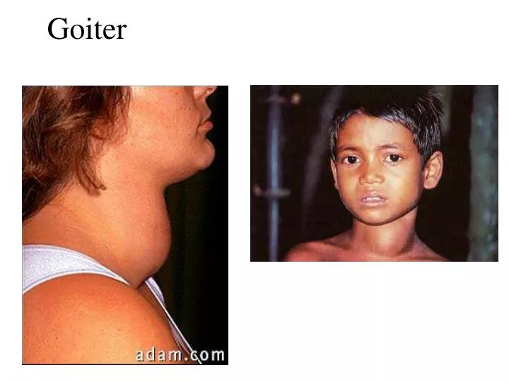 PPT - Goiter PowerPoint Presentation, free download - ID:5614351