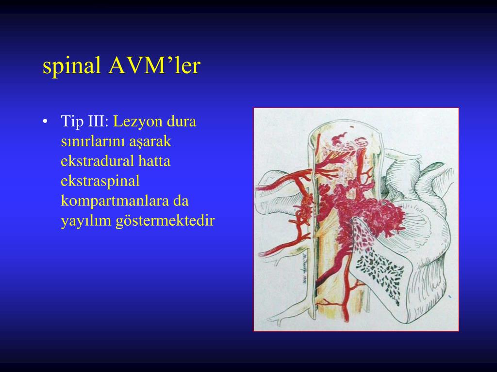 PPT - merkezi sinir sisteminin vasküler malformasyonları PowerPoint ...