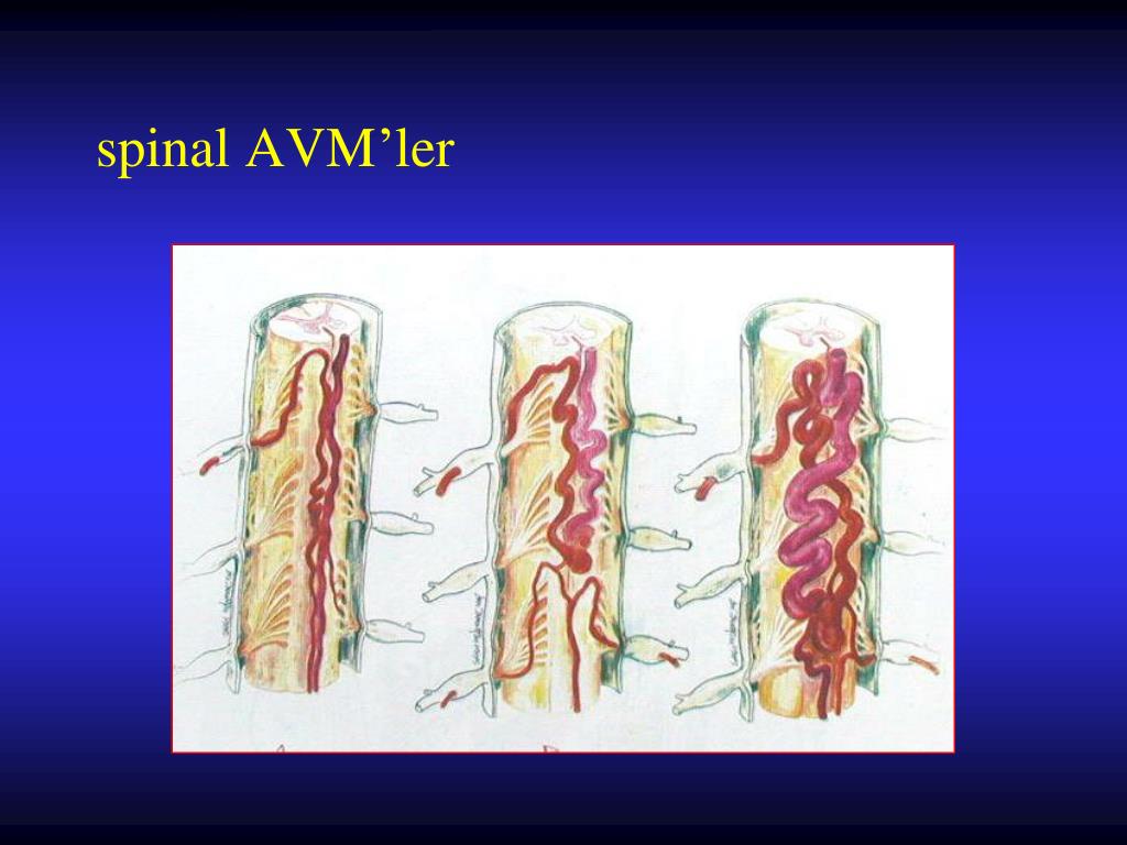 PPT - merkezi sinir sisteminin vasküler malformasyonları PowerPoint ...