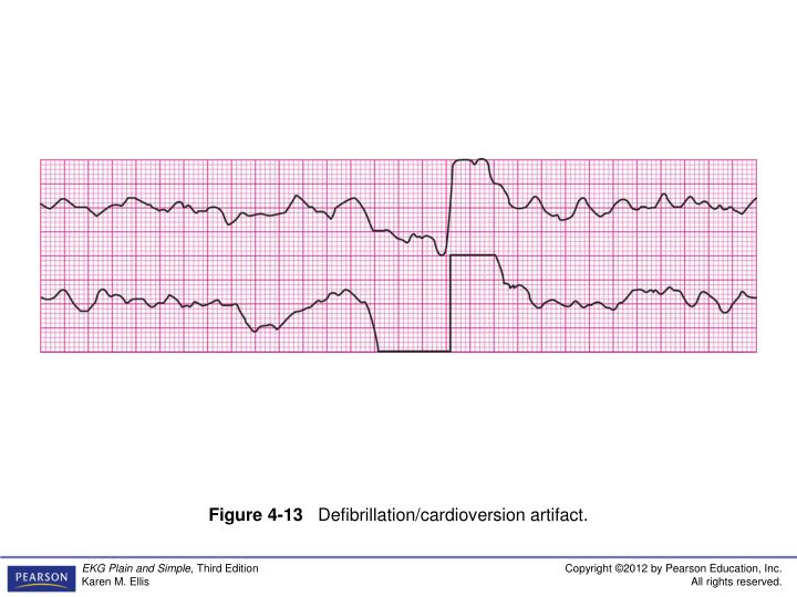 PPT - Figure 4-11 CPR Artifact PowerPoint Presentation - ID:5620621