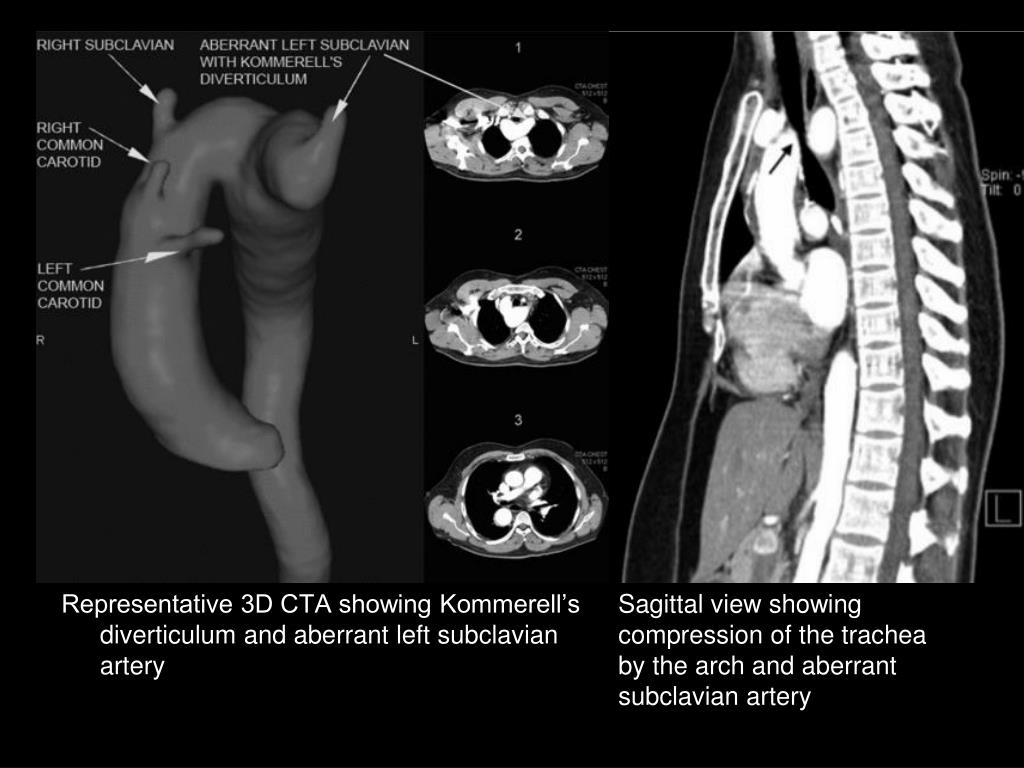 PPT - Kommerell’s Diverticulum Repair with a Right-Sided Aortic Arch ...