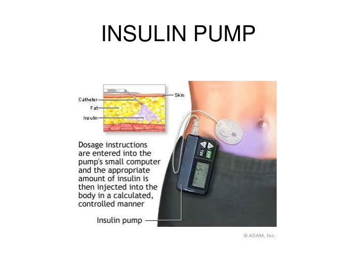 PPT - DIABETES MELLITUS Type 1 PowerPoint Presentation - ID:5635076