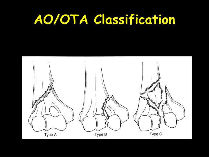 PPT - Surgical Management of Intra-Articular Distal Humerus Fractures ...